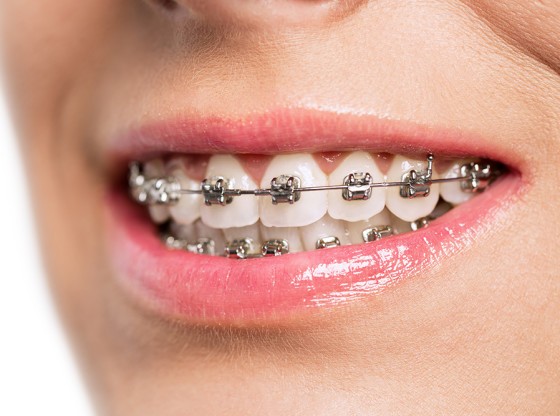 Braces and Gum Disease – Tips for a Healthy Smile - Willamette Valley ...